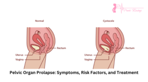 Pelvic Organ Prolapse: Symptoms, Risk Factors, and Treatment